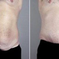 Mini Tummy Tuck videos - Dailymotion