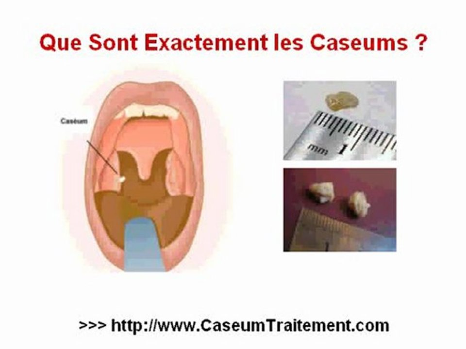 Caséum - Caséums - video Dailymotion