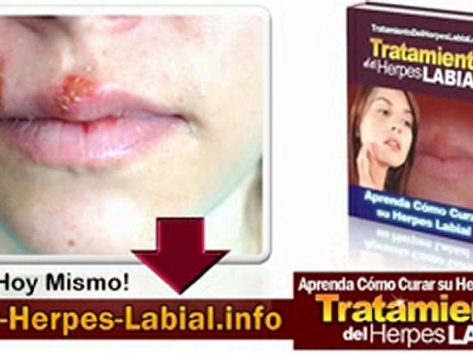 Del Herpes Labial - Tratamiento del Herpes Labial - Vidéo Dailymotion