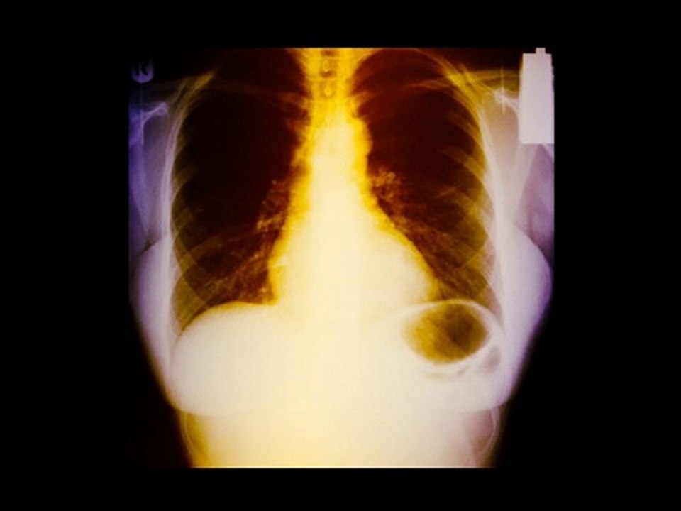 Treat Your Rib Cage Pain With Ease - video Dailymotion