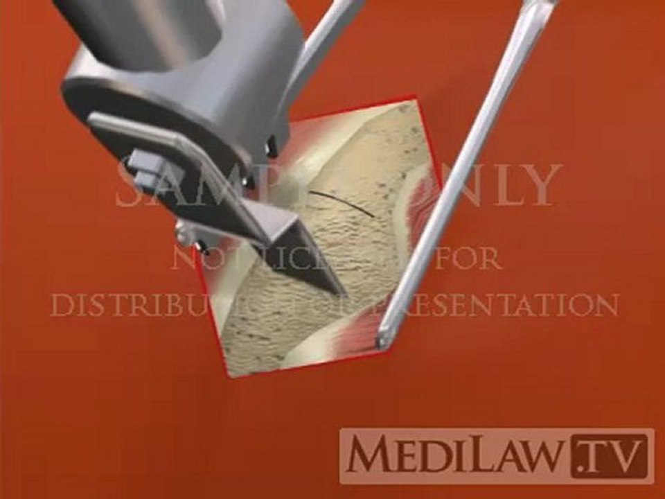 Bone Graft Harvesting Surgery anterior iliac crest neuro-surgical ...