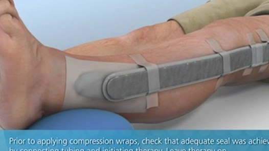 Wound Dressing Application | V.A.C. GranuFoam Bridge XG Dressing | KCI ...