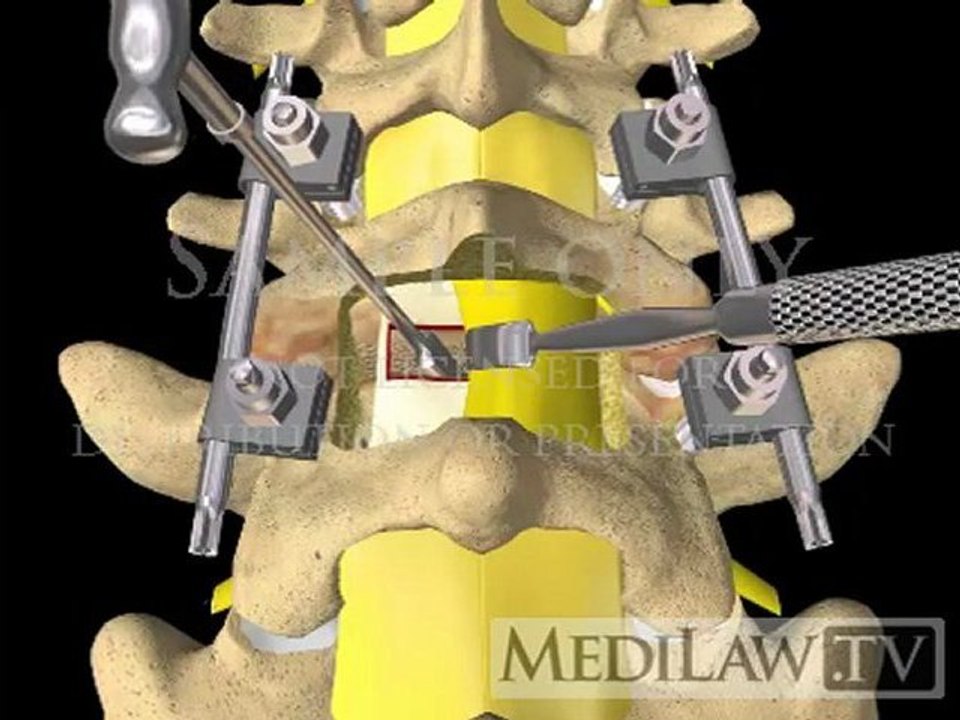 Lumbar Spine Surgery Posterior Interbody Vertebral Fusion with bone ...