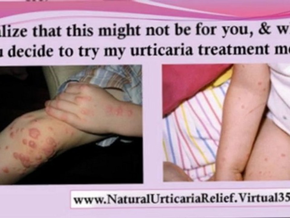 autoimmune chronic urticaria - urticarial vasculitis treatment ...