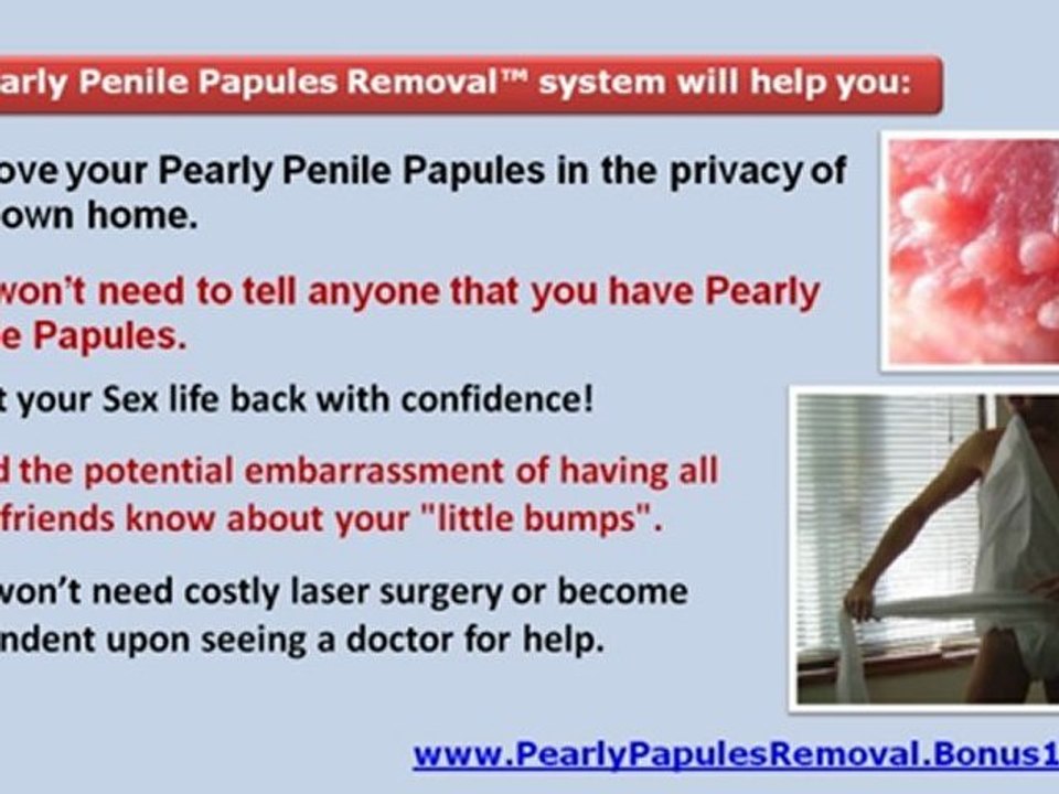 pearly penile papules - pearly penile papules removal at home ...