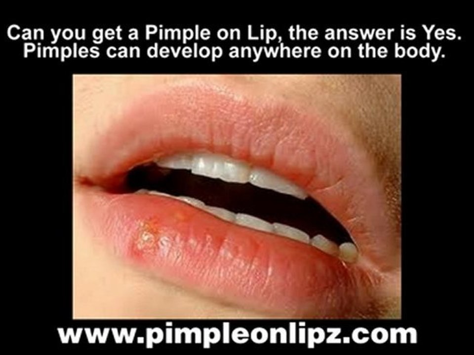 Pimple on Lip How to effectlively treat a pimple on lip . - video ...