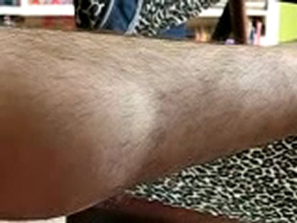 Leg Fasciculations - How To Stop Twitching Limbs - video Dailymotion