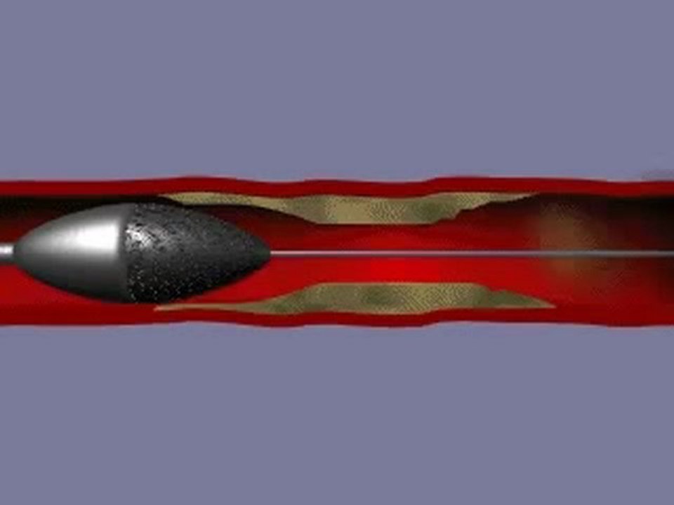 rotablator 3D - video Dailymotion