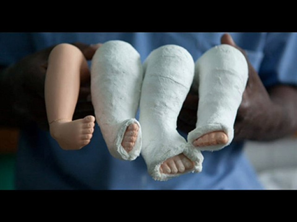 Ponseti Method - video Dailymotion