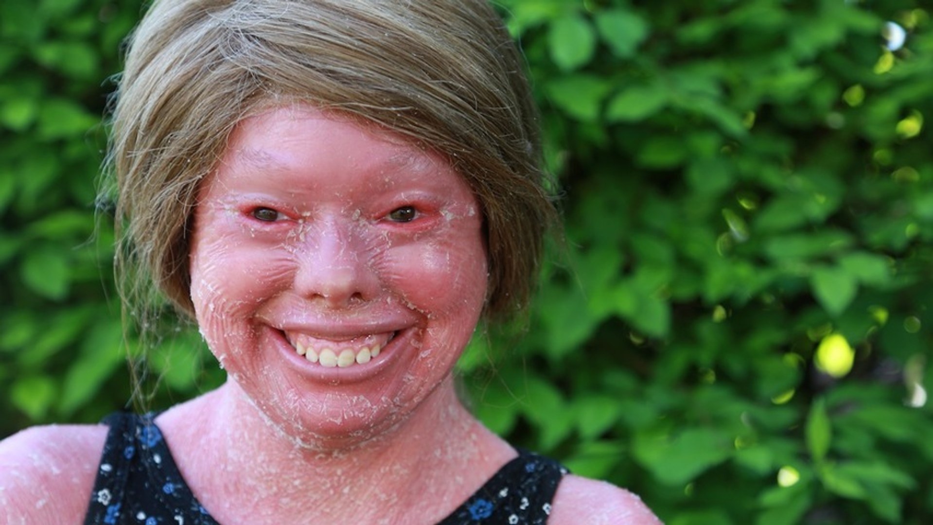 Harlequin Ichthyosis Survivor EXPECTING THE MOST UNEXPECTED – A