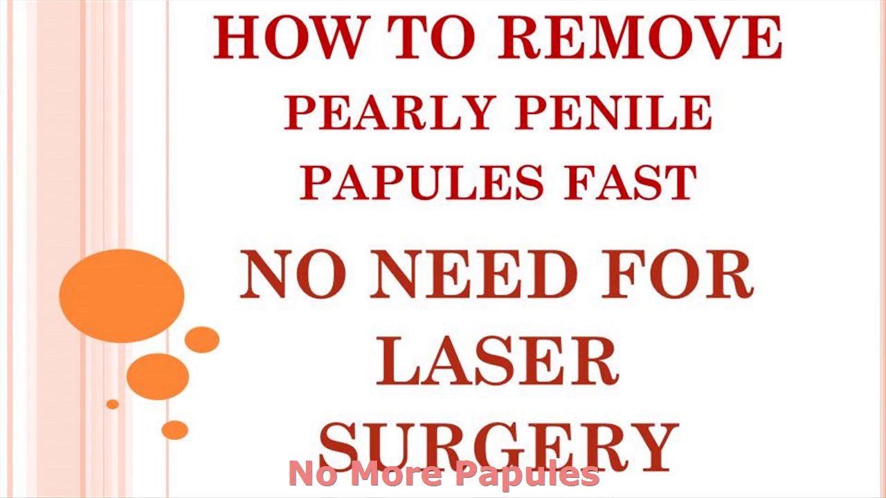 Pearly Penile Papules Effects - video Dailymotion