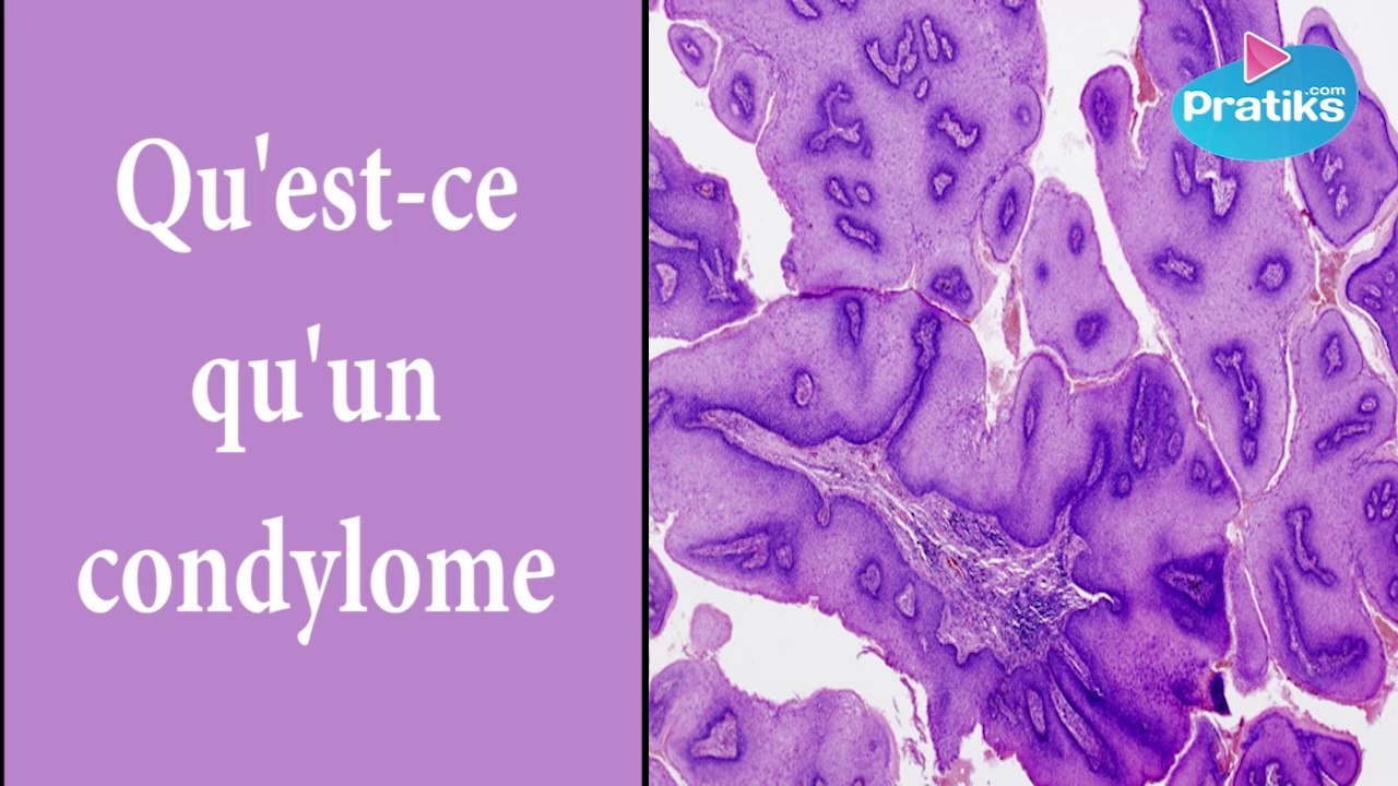 Proctologie - Qu'est-ce qu'un condylome - Vidéo Dailymotion