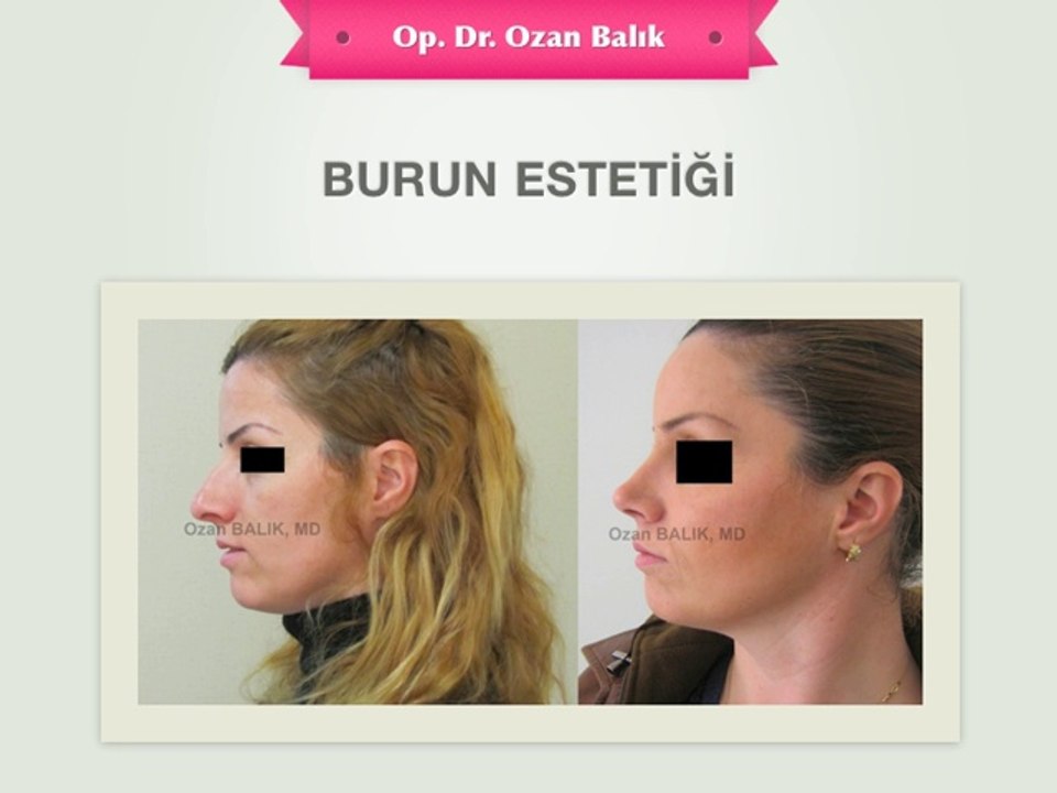 Burun Estetiği - Öncesi Sonrası Resimleri - Dailymotion Video