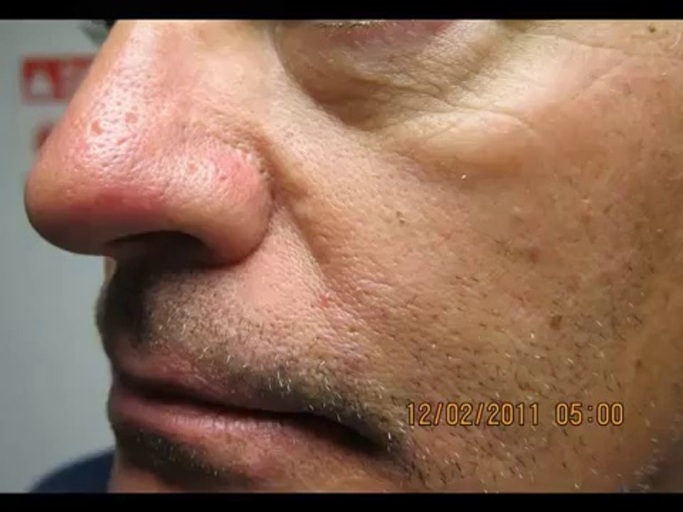 Before and After Pictures-Rosacea-Rhinophyma - video Dailymotion