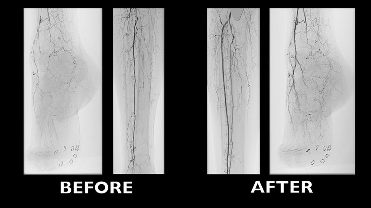 Vidéo : Angioplasty of anterior tibial artery and dorsalis pedis in a ...