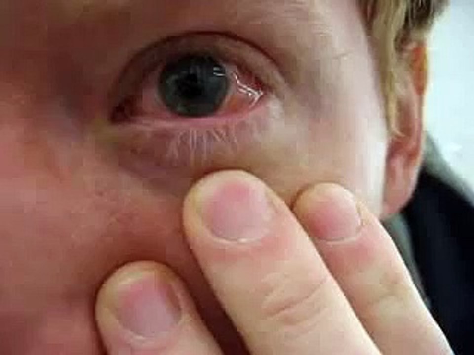 Pingueculitis or Episcleritis? - video Dailymotion