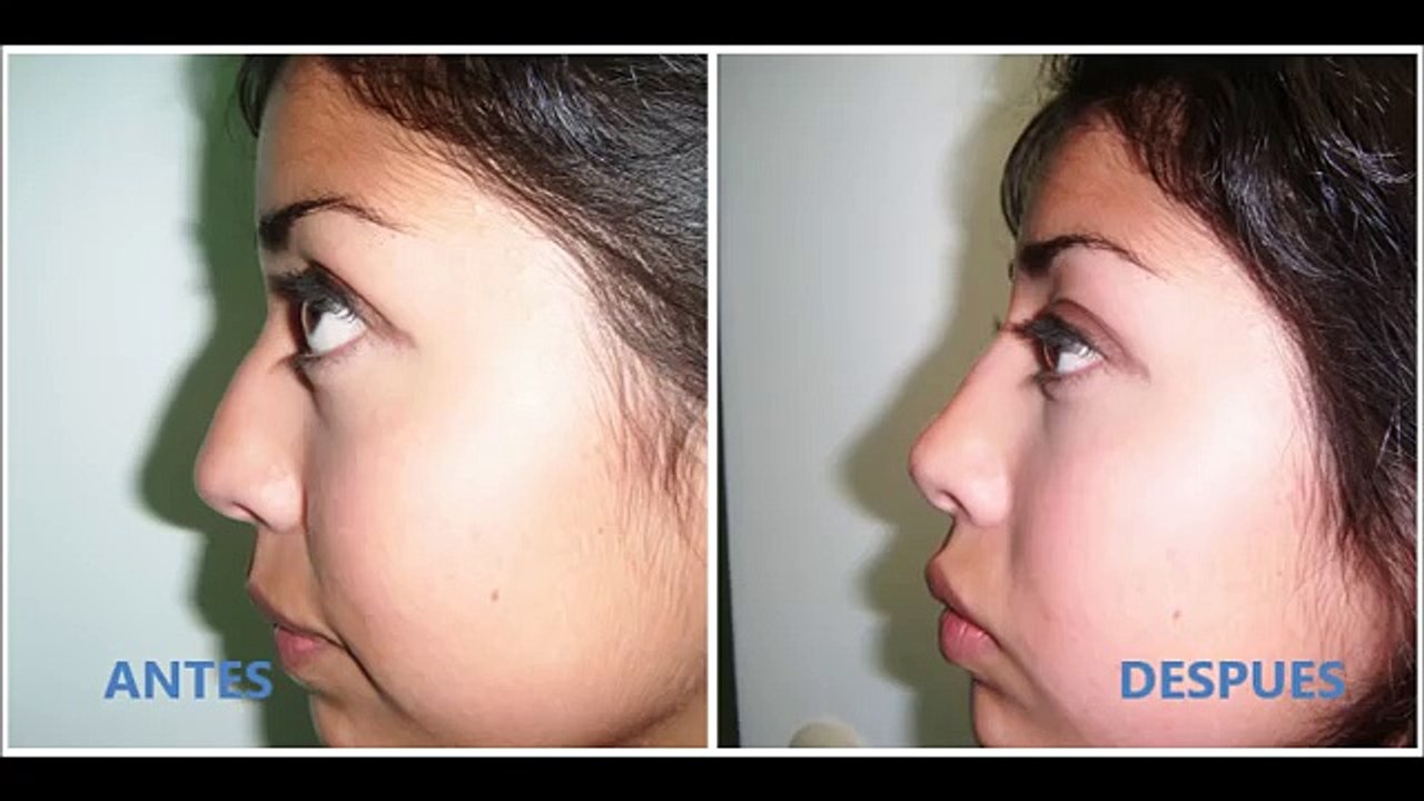 NARIZ RECTA O RESPINGADA EN MINUTOS (SIN PALITOS) - video Dailymotion