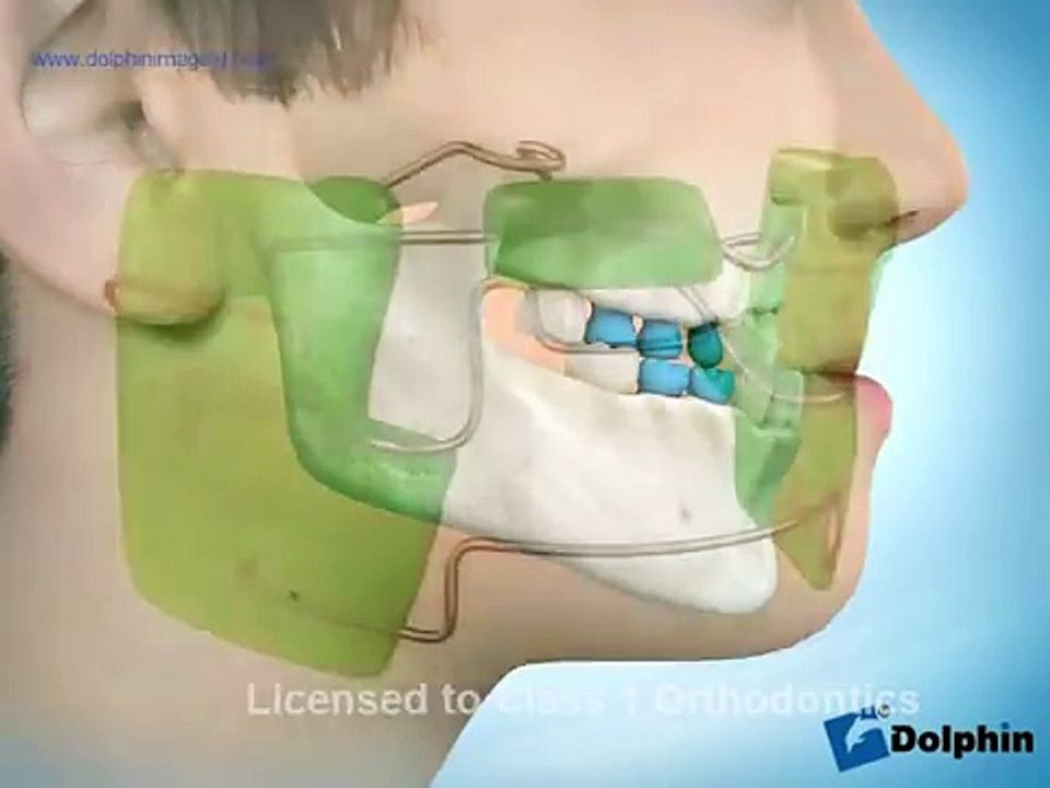 Frankel III Class 1 Orthodontics - video Dailymotion