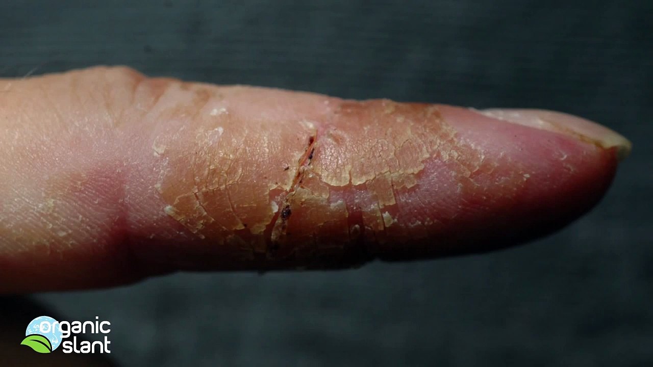 Finger laceration time lapse healing | Organic Slant - video Dailymotion