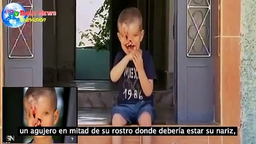Conoce La Historia Del Niño Que Nació Sin Ojos Sin Mandibula Y Sin