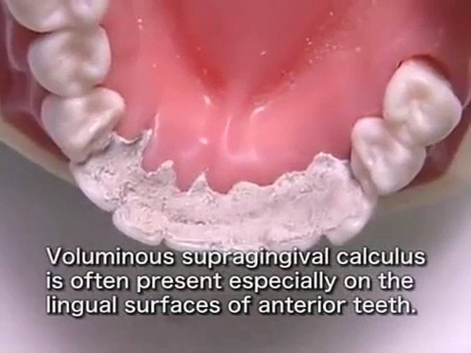 Scaling calculus on anterior lingual teeth - video Dailymotion