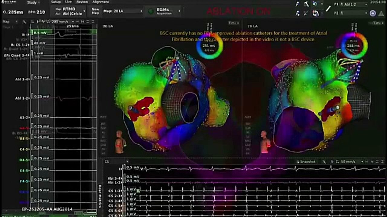 Introduction to the Rhythmia™ Mapping System - video Dailymotion