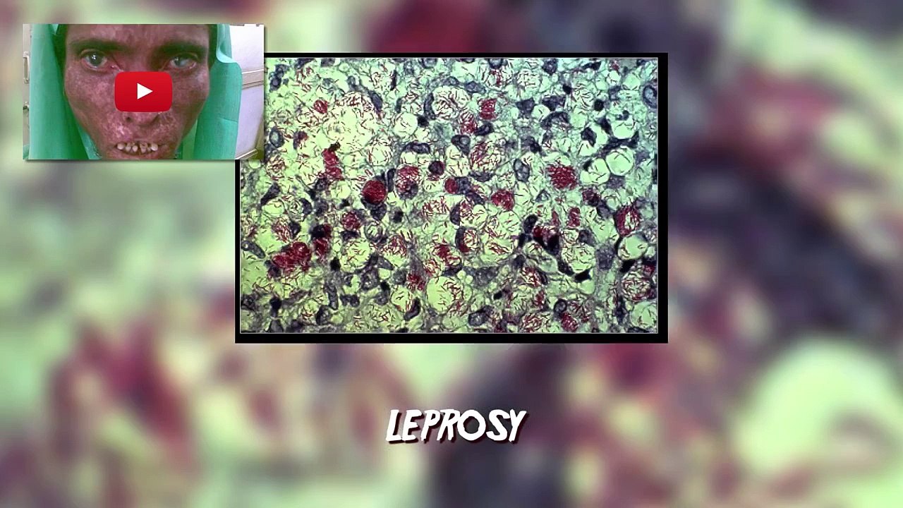 10 Scariest Diseases in the World - Vidéo Dailymotion