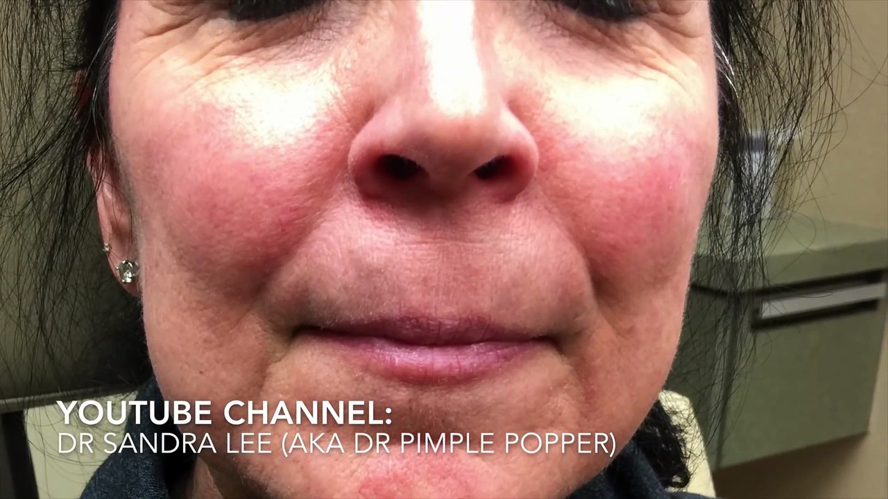 Crazy extraction of years old Blackhead on upper Lip!! - Vidéo Dailymotion