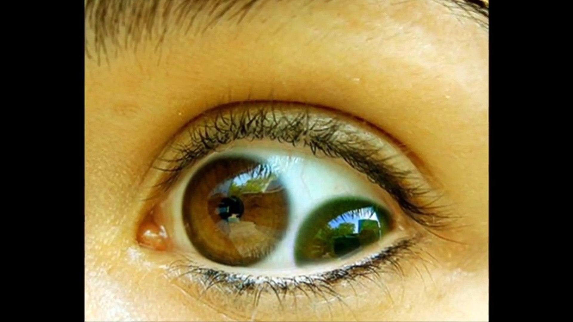 Two Pupils In One Eye