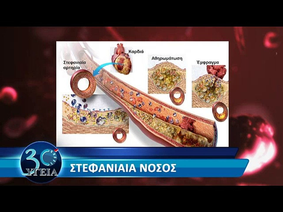 30' Υγεια - 04-05-16 (Στεφανιαια Νοσος - Bypass) - video Dailymotion