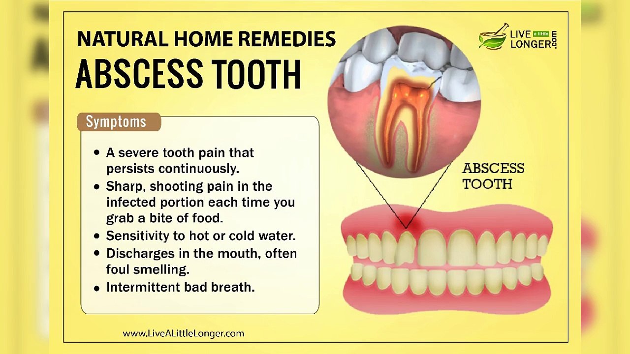 Natural Home Remedies for Abcess tooth - video Dailymotion