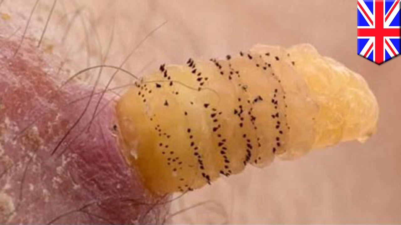 Gross! Flesh-eating maggots burrow into woman’s arm - video Dailymotion
