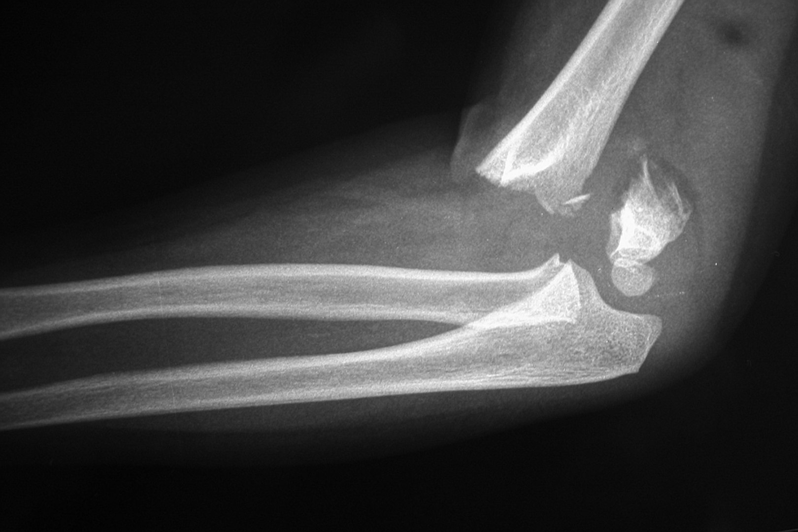Radiografía Del Brazo Roto De Un Niño
