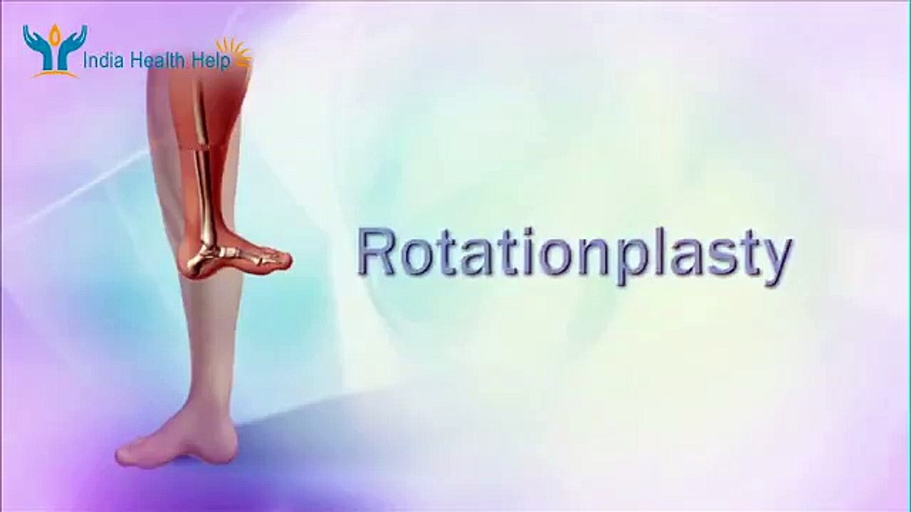 Limb Prosthesis Surgery in India | Rotationplasty Surgery - video ...