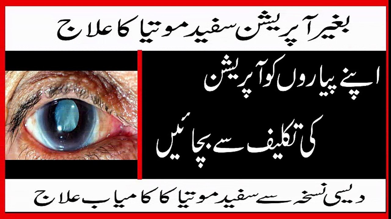 safed motia ka ilaj in urdu | Bagair Operation Motiya (Cataract) ka ...
