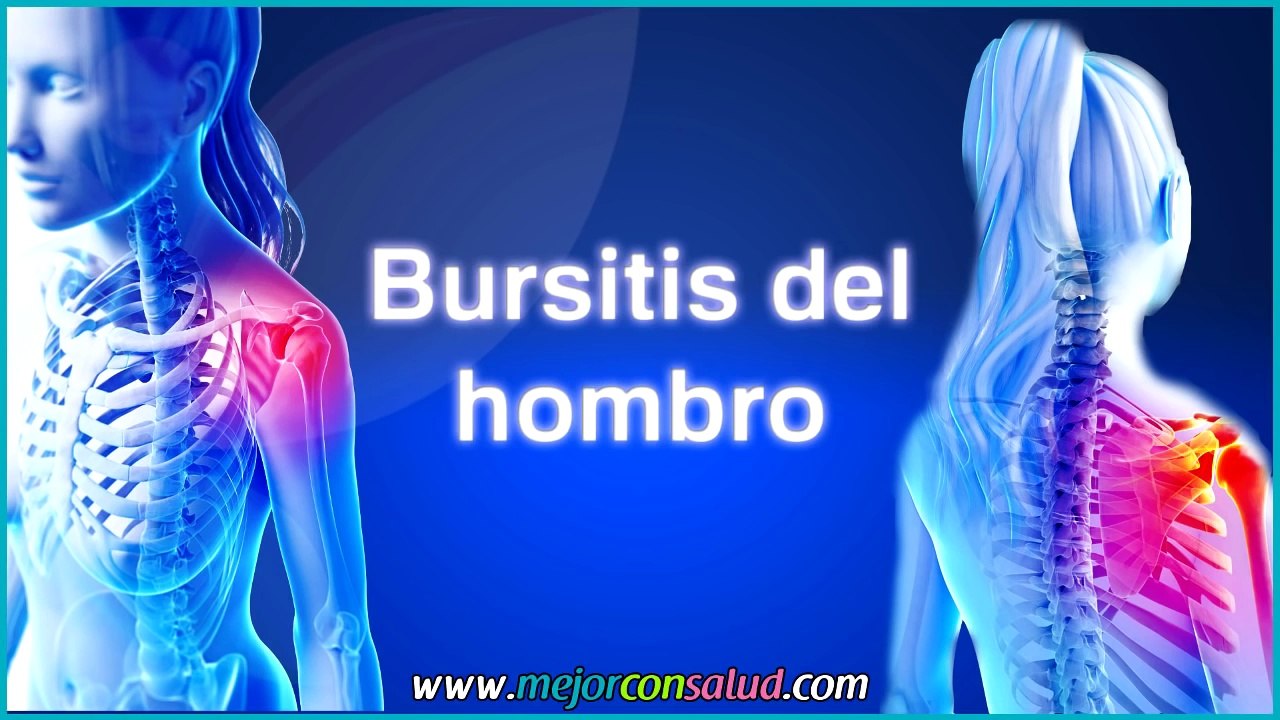 La bursitis de hombro - Qué es, síntomas y tratamiento - Vídeo Dailymotion