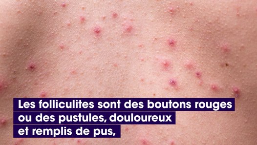 Les différents types de boutons dans les zones intimes - Vidéo Dailymotion