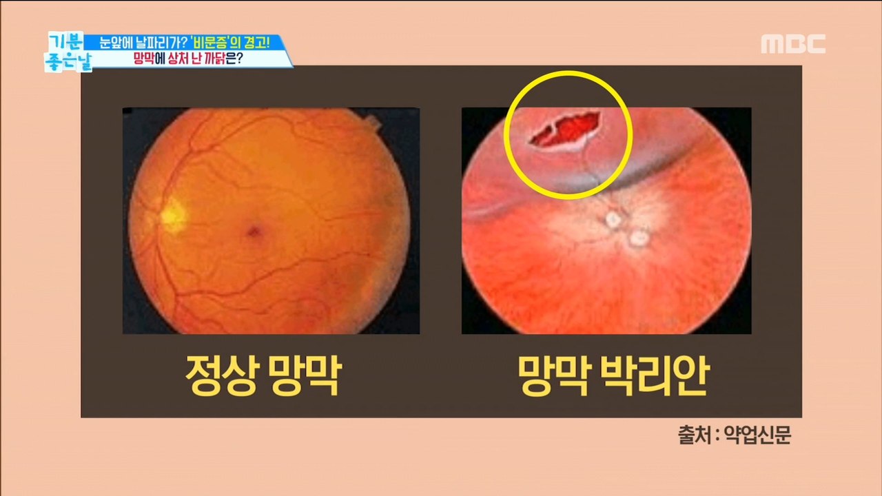 living-even-if-i-have-good-eyesight-is-there-a-risk-of-blindness