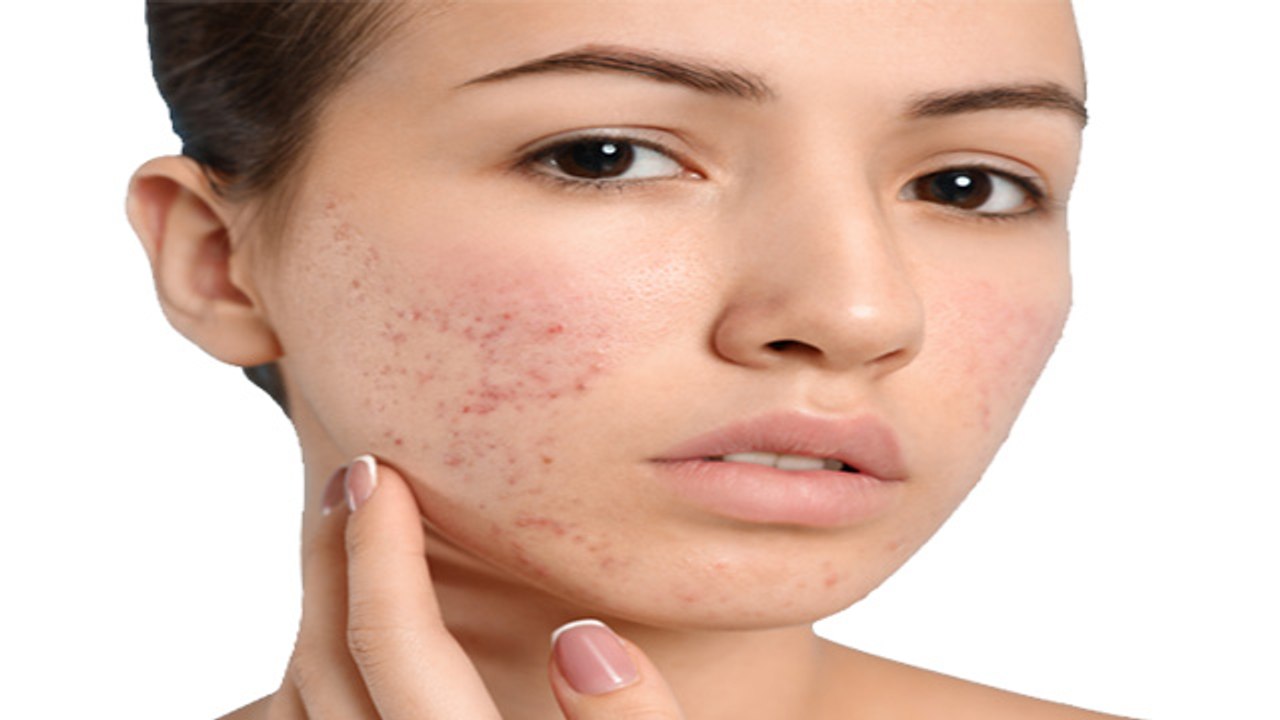 मुंहासे हटाने का उपाय, सबसे असरदार घरेलू उपाय से रातभर में मिलेगा ...