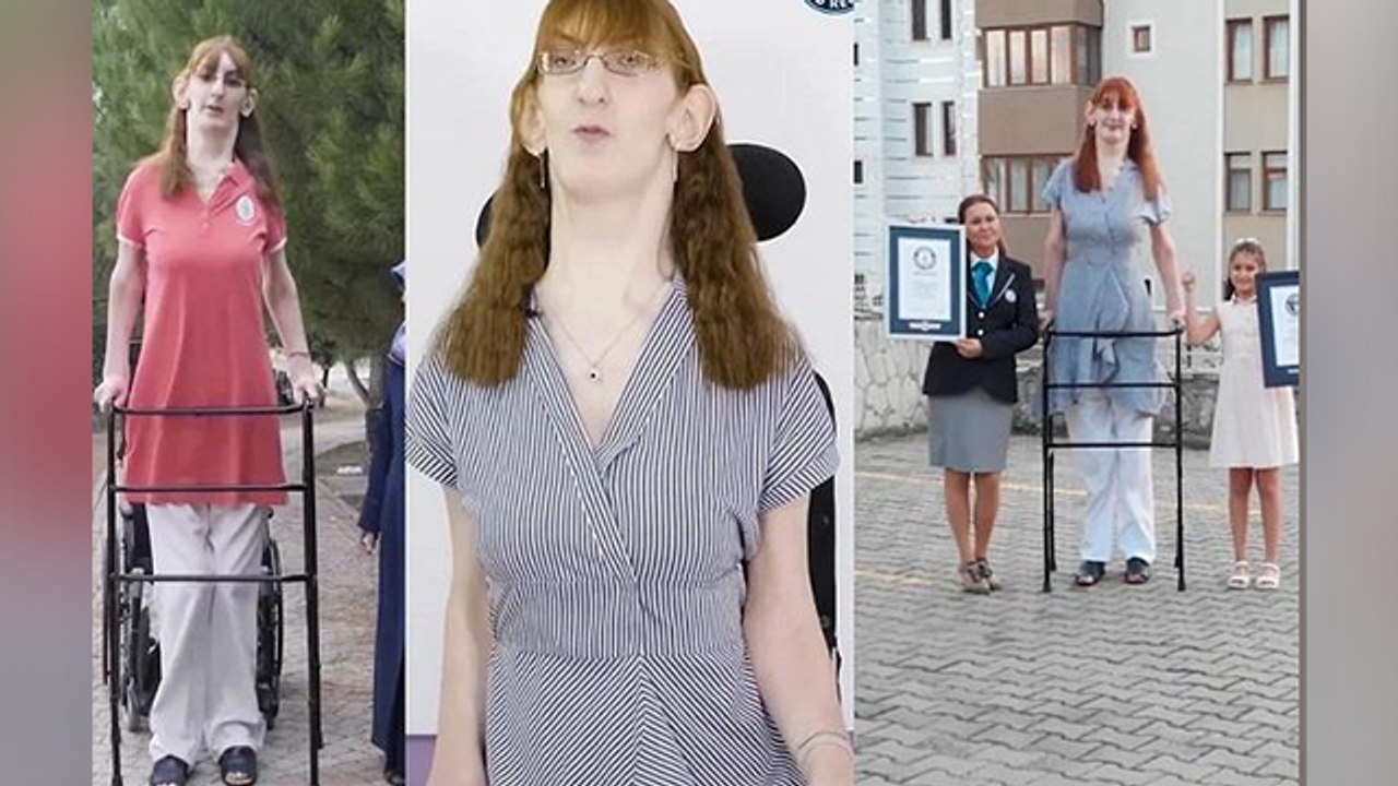 Rumeysa Gelgi का Weaver Syndrome से Guinness World Record, Height बढ़ी ...