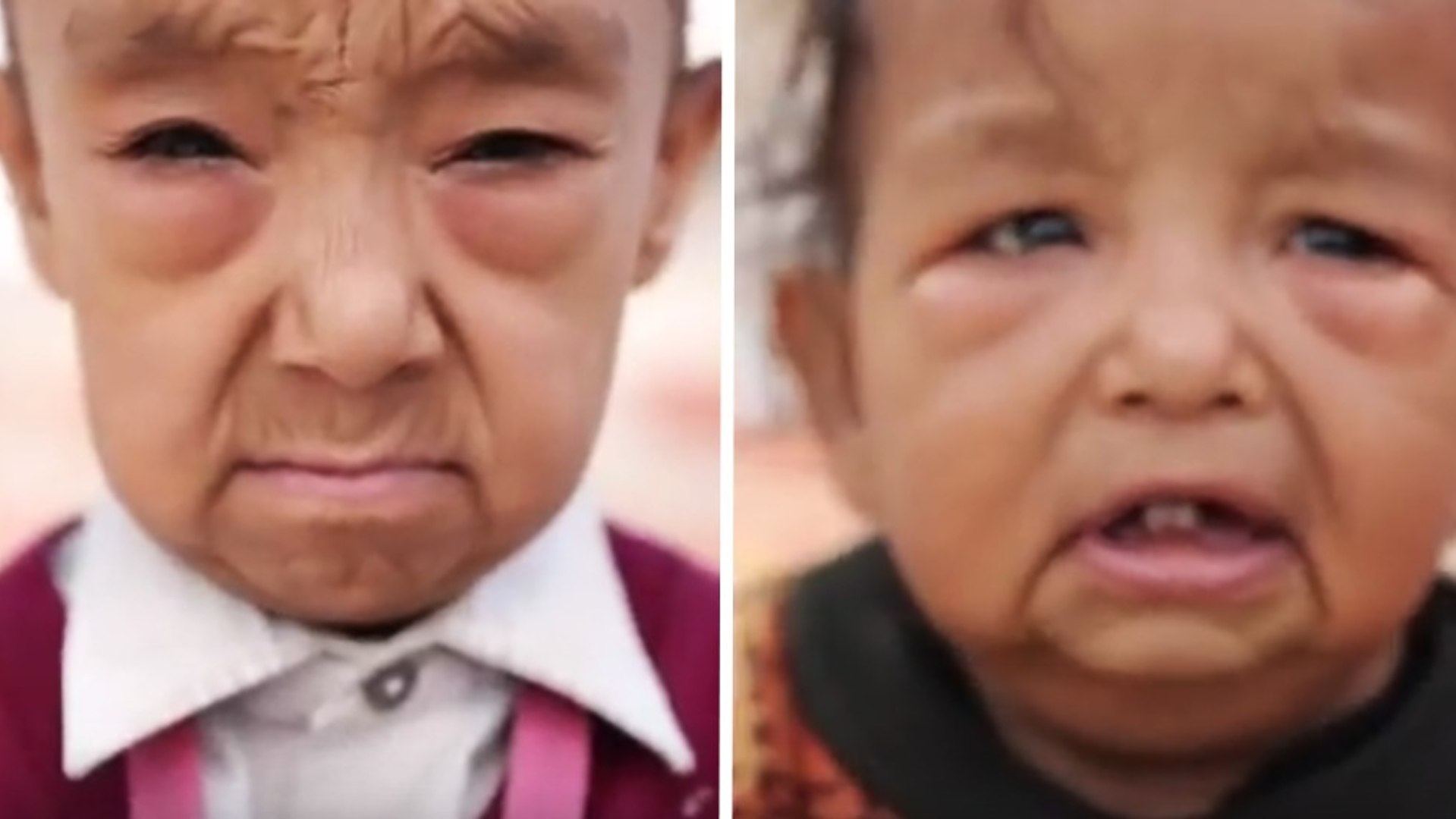 Enfants Atteints De Progéria Grâce à Une Collecte, Une Petite Fille