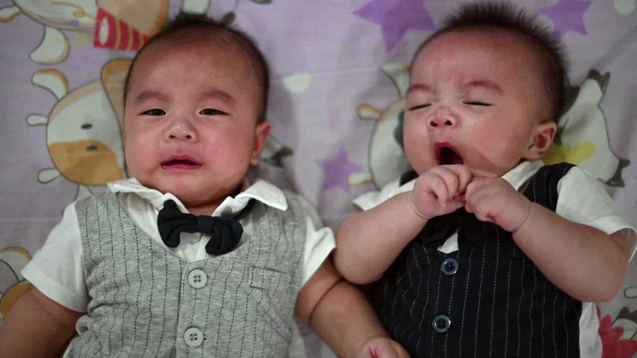 Baby born with parasitic ‘headless’ twin attached to its back - video ...