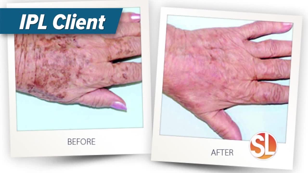 Turn Back Time Spa & Wellness Clinic offers up IPL to repair damaged ...