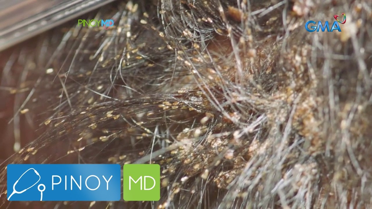 Pinoy MD: Paano maiiwasan ang pagkakaroon ng kuto? - video Dailymotion
