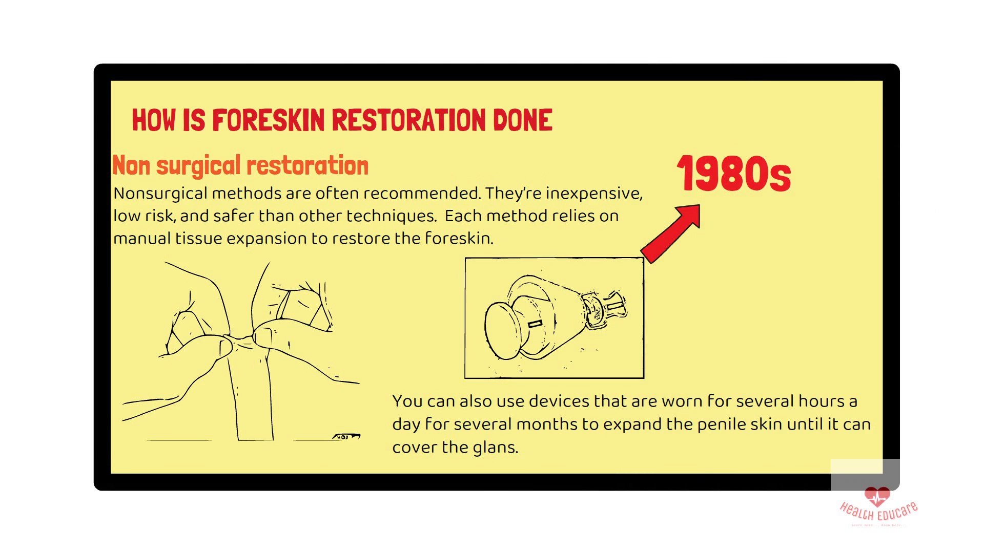 Foreskin Restoration