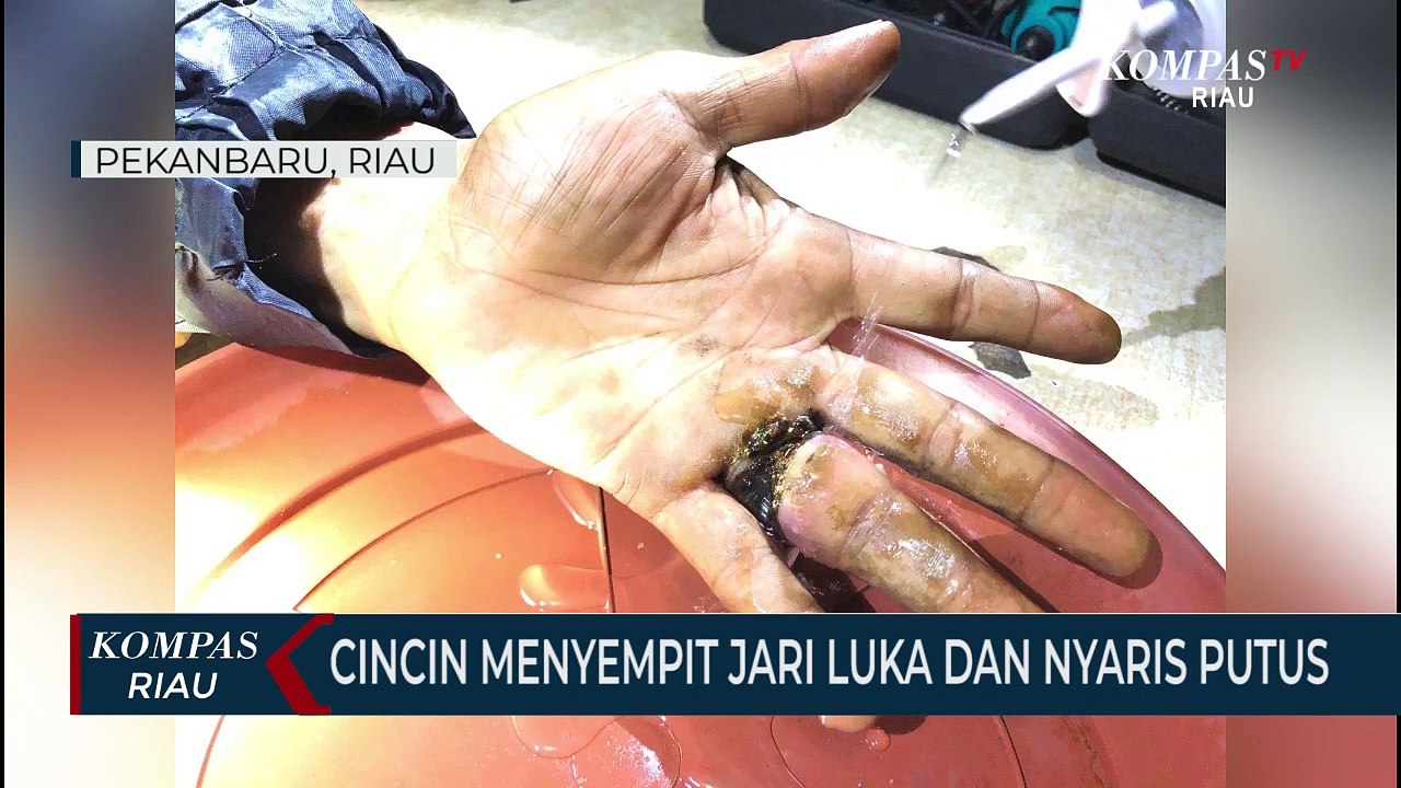Cincin Menyempit Jari Luka Dan Nyaris Putus - Video Dailymotion