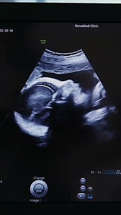 Baby Scan video - video Dailymotion