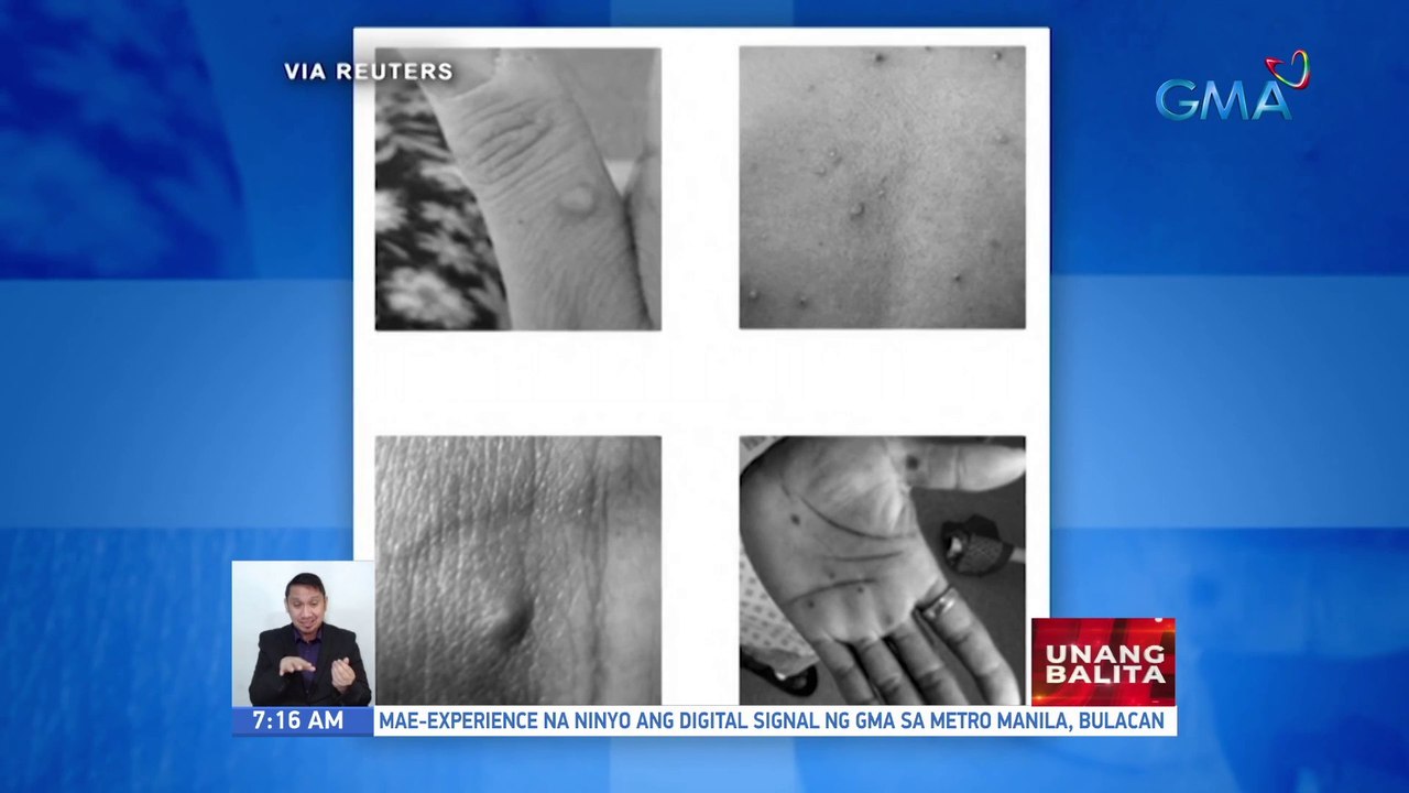 Monkeypox, wala pang lunas o gamot; Pag-develop ng antiviral agents ...