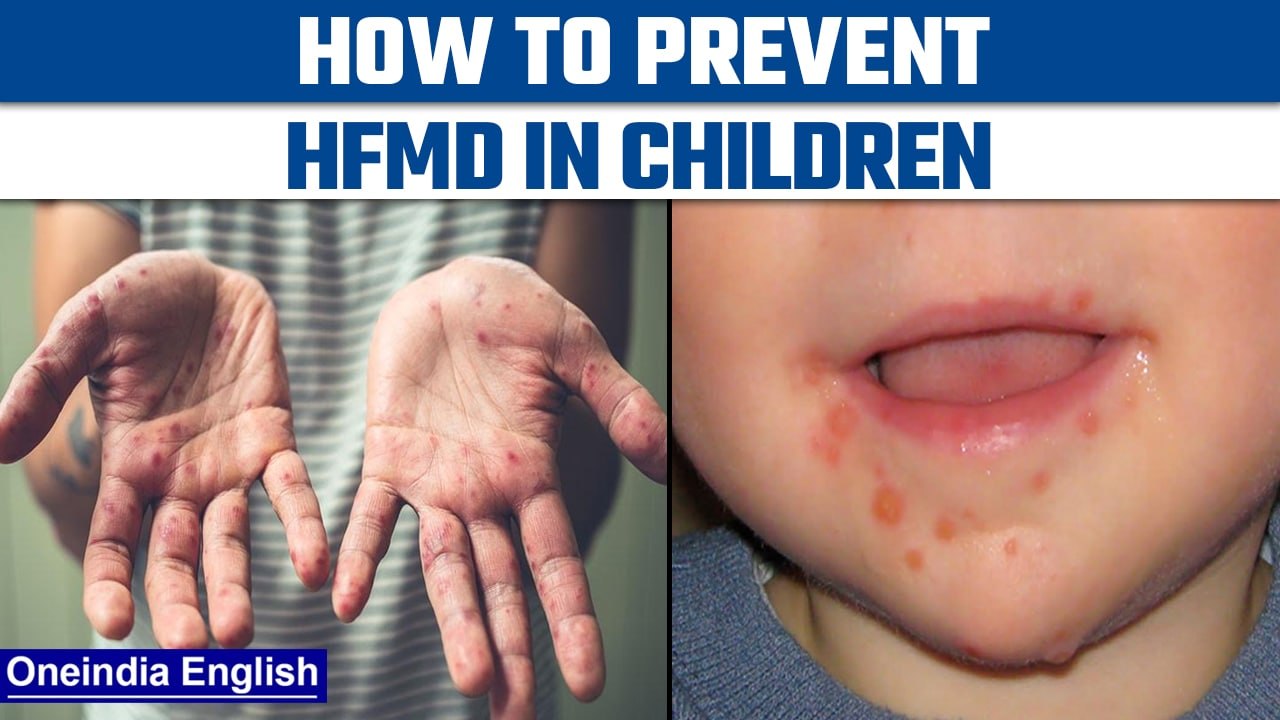 What are HFMD diseases | How to prevent HFMD in children| Oneindia News ...