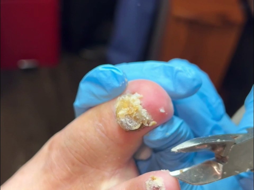 RAM'S HORN NAIL DEBRIDEMENT - video Dailymotion